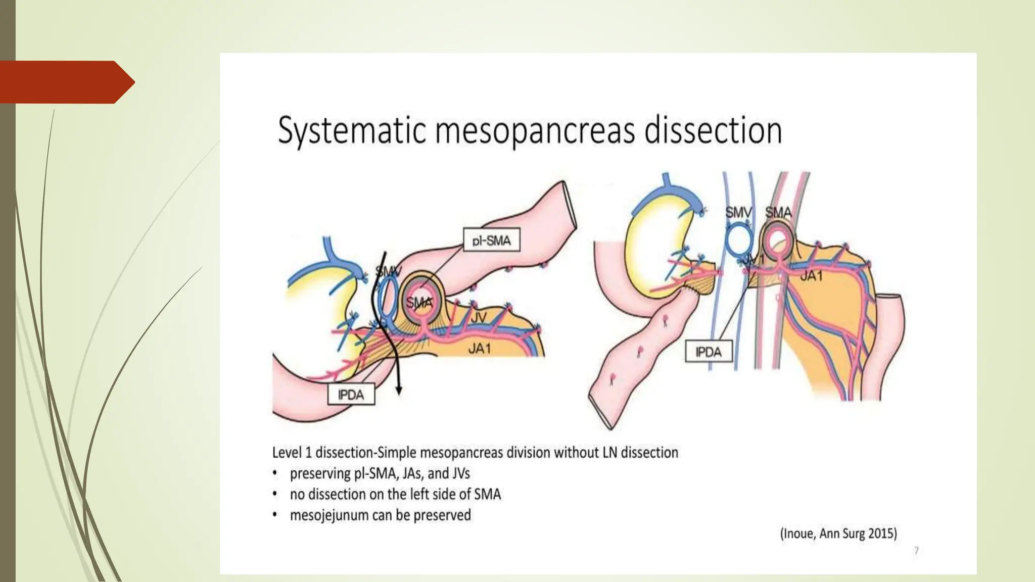 Management of MESOPANCREAS& TRIANGLE OPERATION.pptx