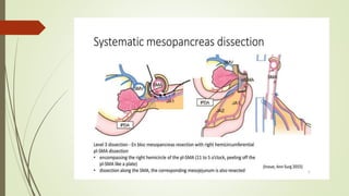 Management of MESOPANCREAS& TRIANGLE OPERATION.pptx