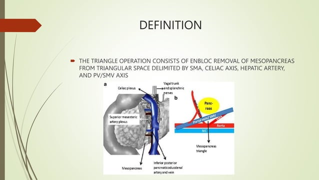 Management of MESOPANCREAS& TRIANGLE OPERATION.pptx