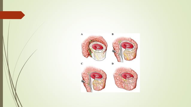 Management of MESOPANCREAS& TRIANGLE OPERATION.pptx