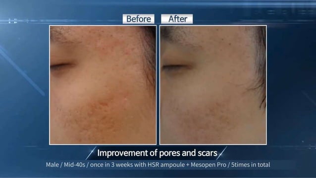 Microneedling Benefits | PPTX | Skin and Dermatology | Diseases and ...