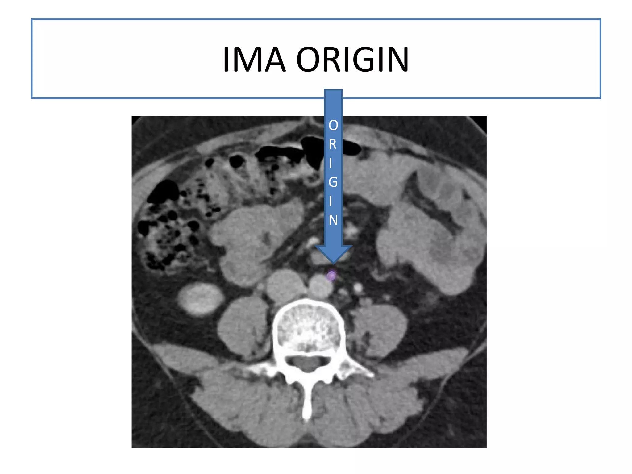 MESORECTUM TARGET DELINEATION | PPTX