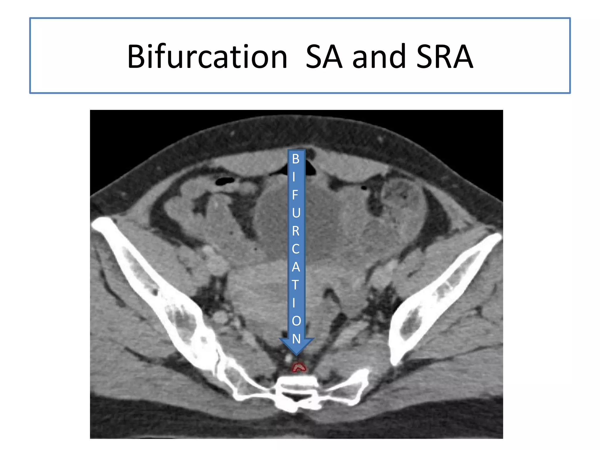 MESORECTUM TARGET DELINEATION | PPTX