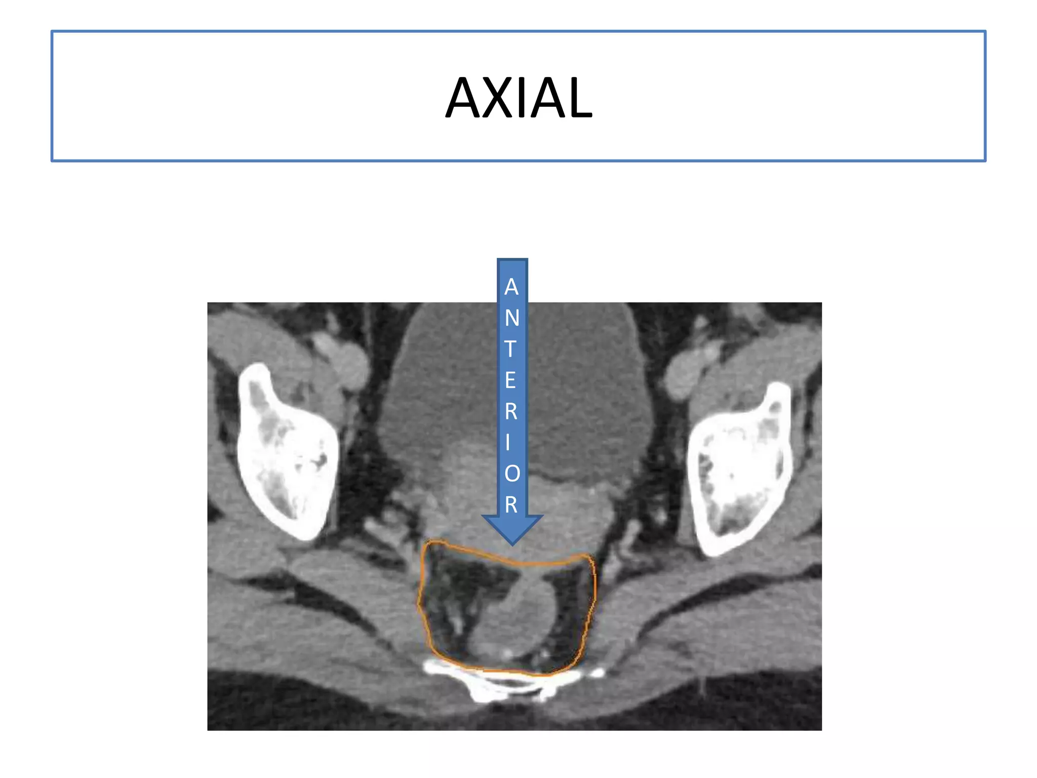 MESORECTUM TARGET DELINEATION | PPTX