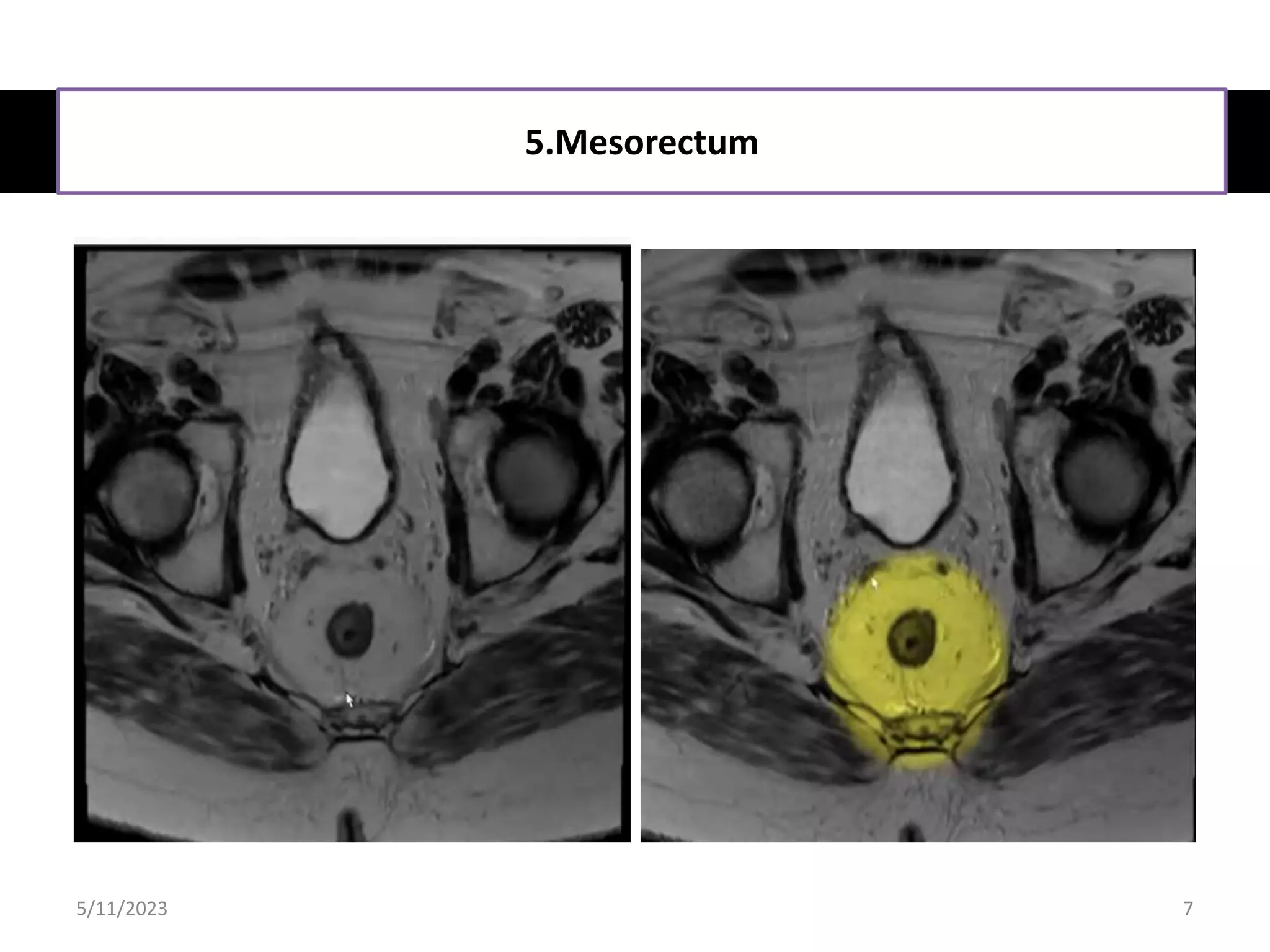 MESORECTUM TARGET DELINEATION | PPTX