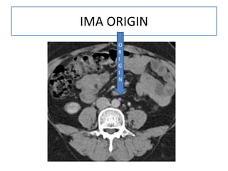 MESORECTUM TARGET DELINEATION | PPTX