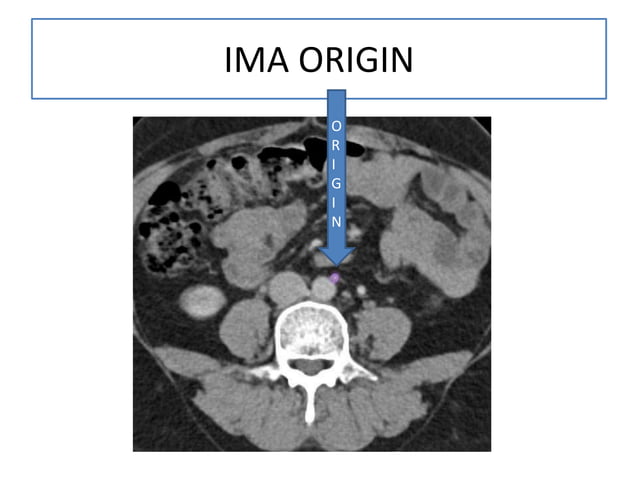 MESORECTUM TARGET DELINEATION | PPTX