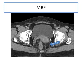 MESORECTUM TARGET DELINEATION | PPTX