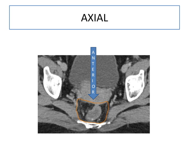 MESORECTUM TARGET DELINEATION | PPTX