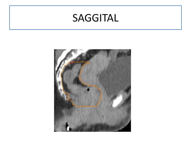 MESORECTUM TARGET DELINEATION | PPTX