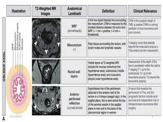 MESORECTUM TARGET DELINEATION | PPTX