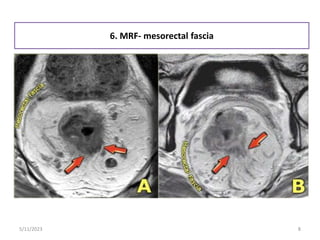 MESORECTUM TARGET DELINEATION | PPTX