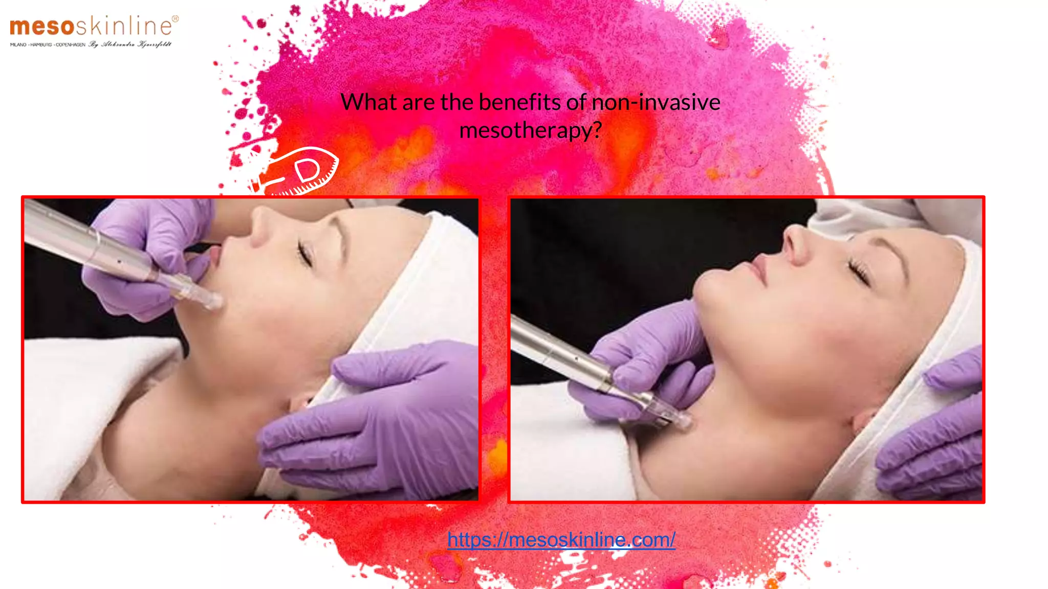 Mesotherapy for stretch marks | mesoskinline | PPTX | Physical Therapy ...