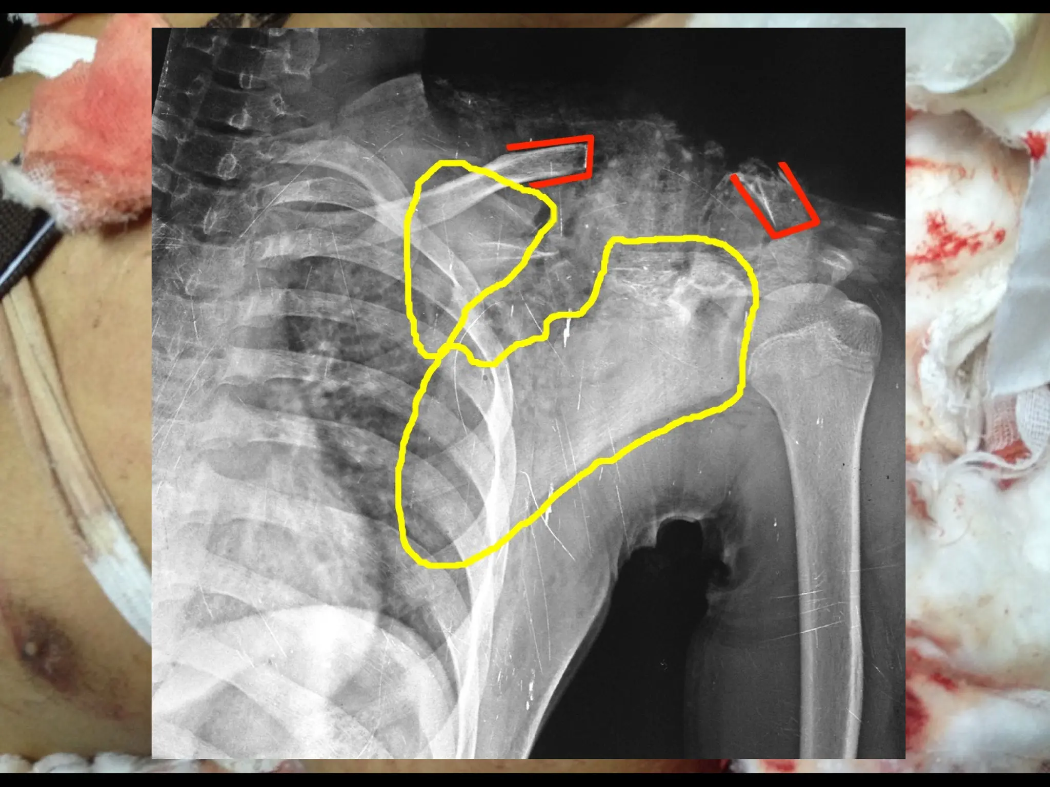 Mangled extremities: assessment scoring and management | PPTX