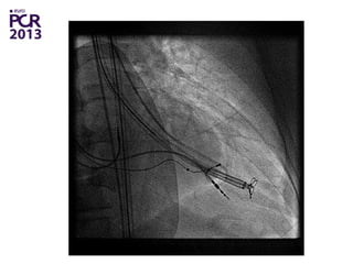 Meta analysis of percutaneous ventricular restoration (pvr) therapy ...