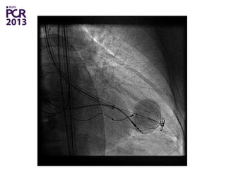 Meta analysis of percutaneous ventricular restoration (pvr) therapy ...