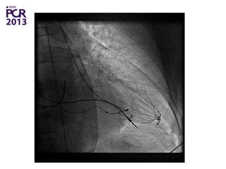 Meta analysis of percutaneous ventricular restoration (pvr) therapy ...