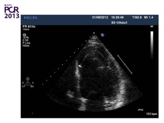 Meta analysis of percutaneous ventricular restoration (pvr) therapy ...