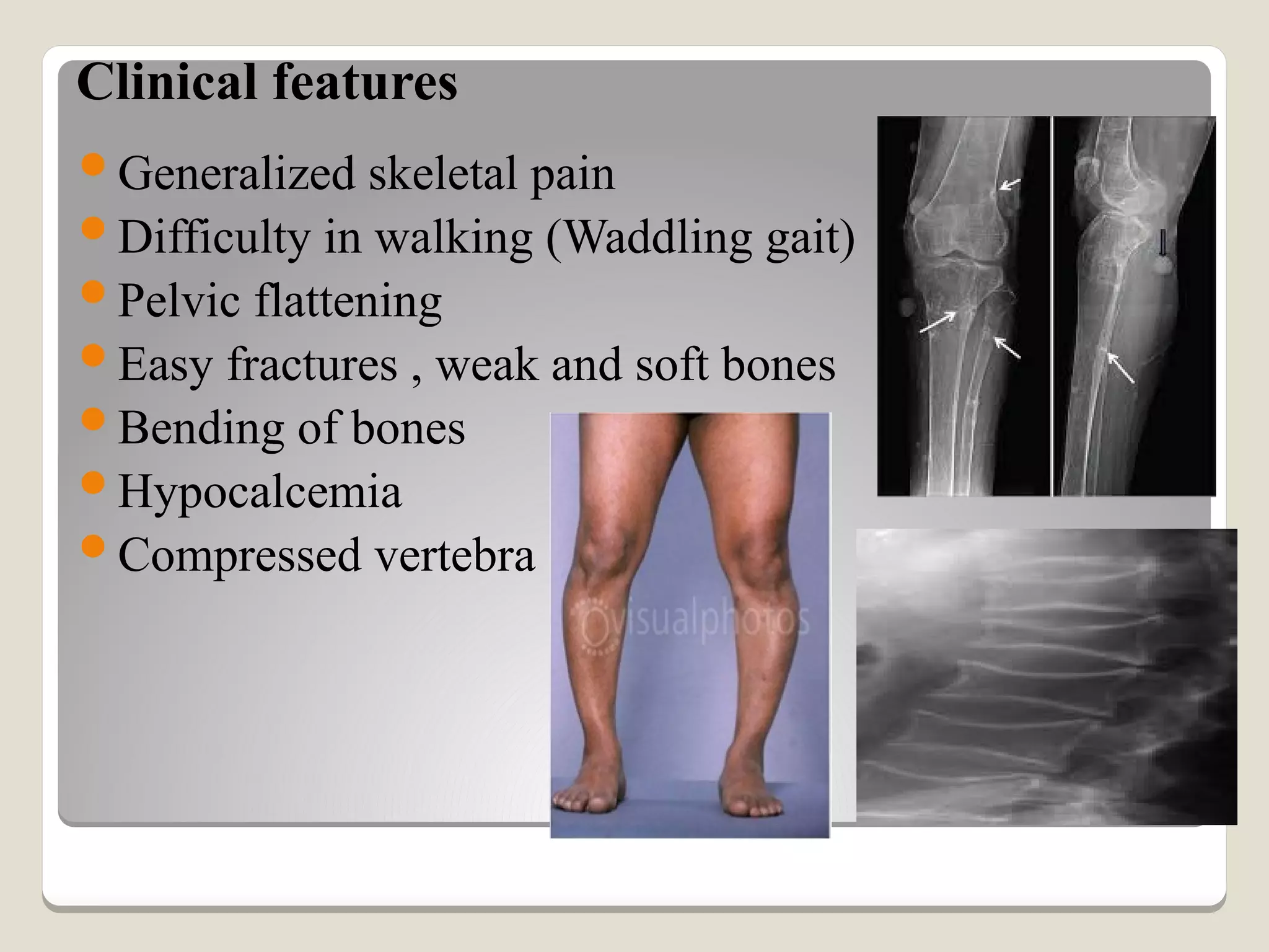 Metabolic bone disease | PDF