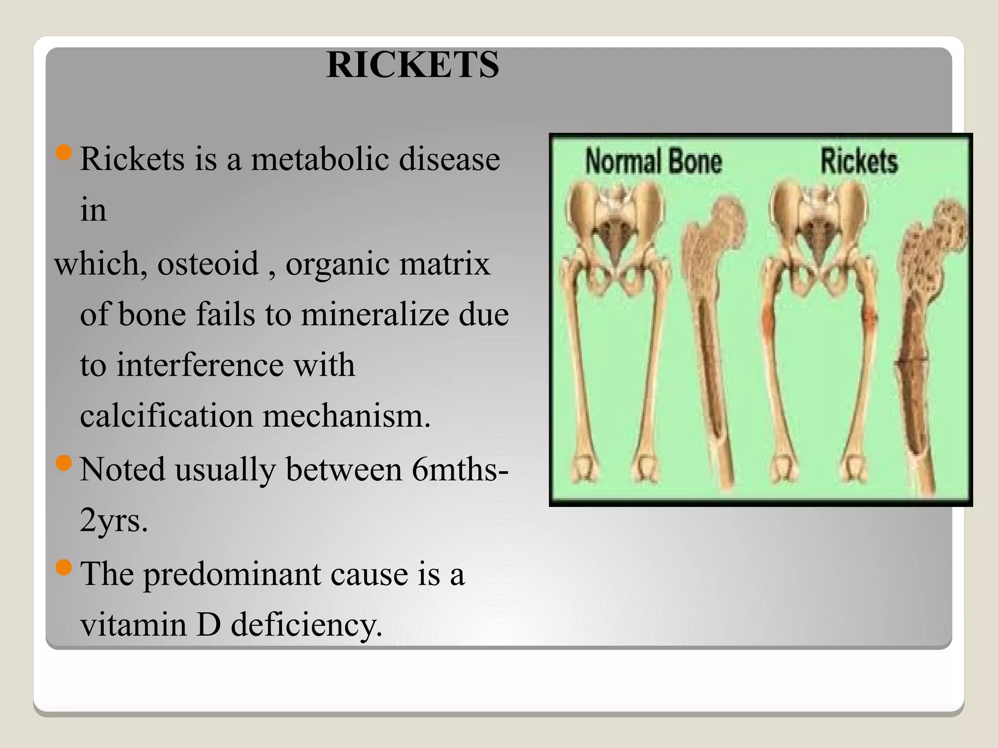 Metabolic bone disease | PDF
