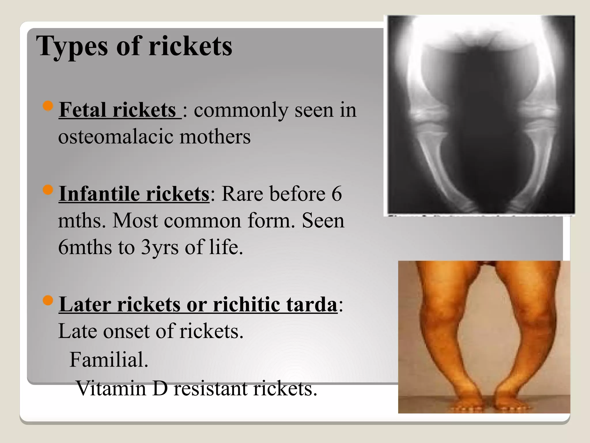 Metabolic bone disease | PDF