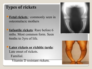 Metabolic bone disease | PDF