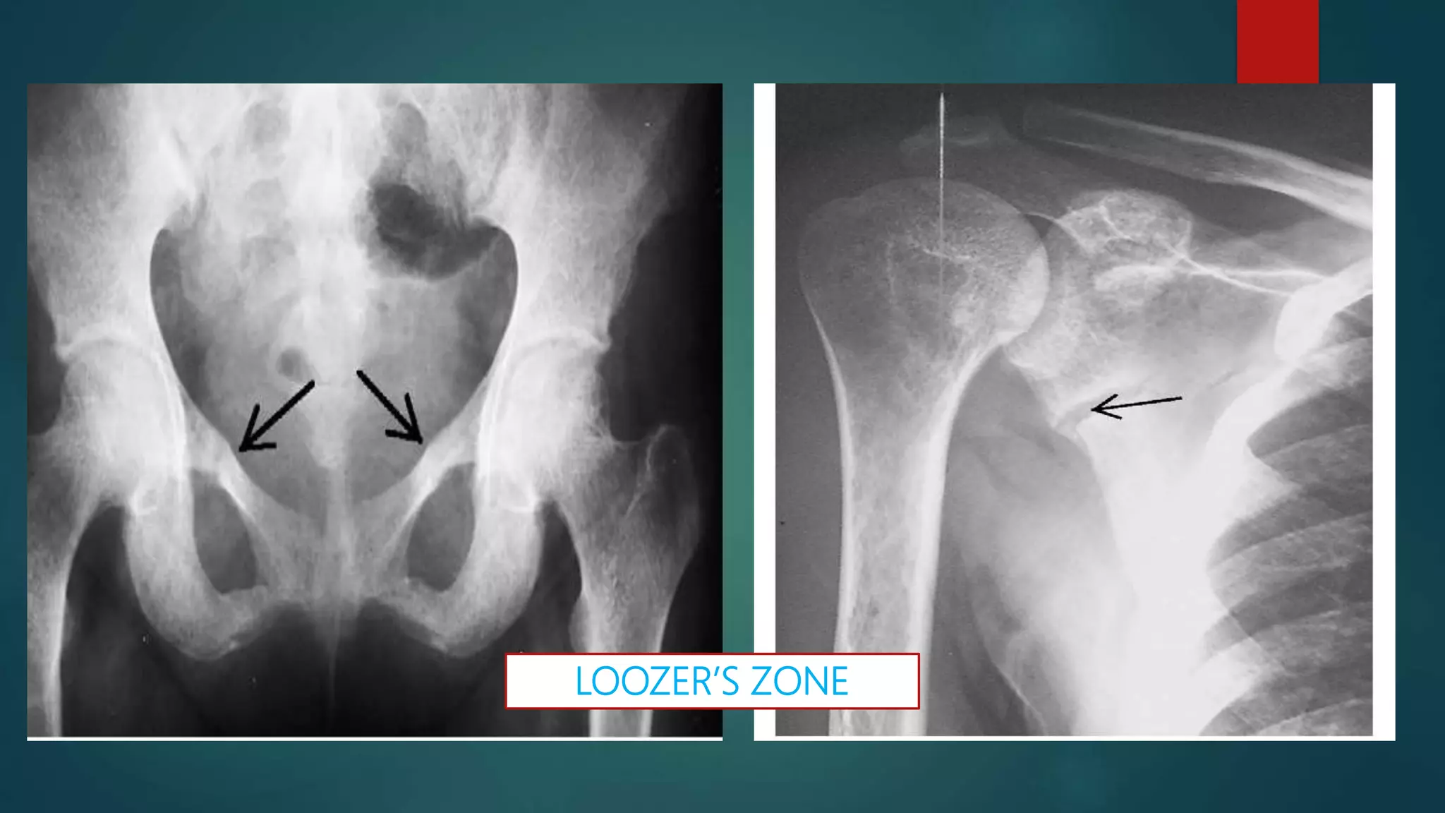 Metabolic & Endocrinal Diseases affecting bone | PPTX