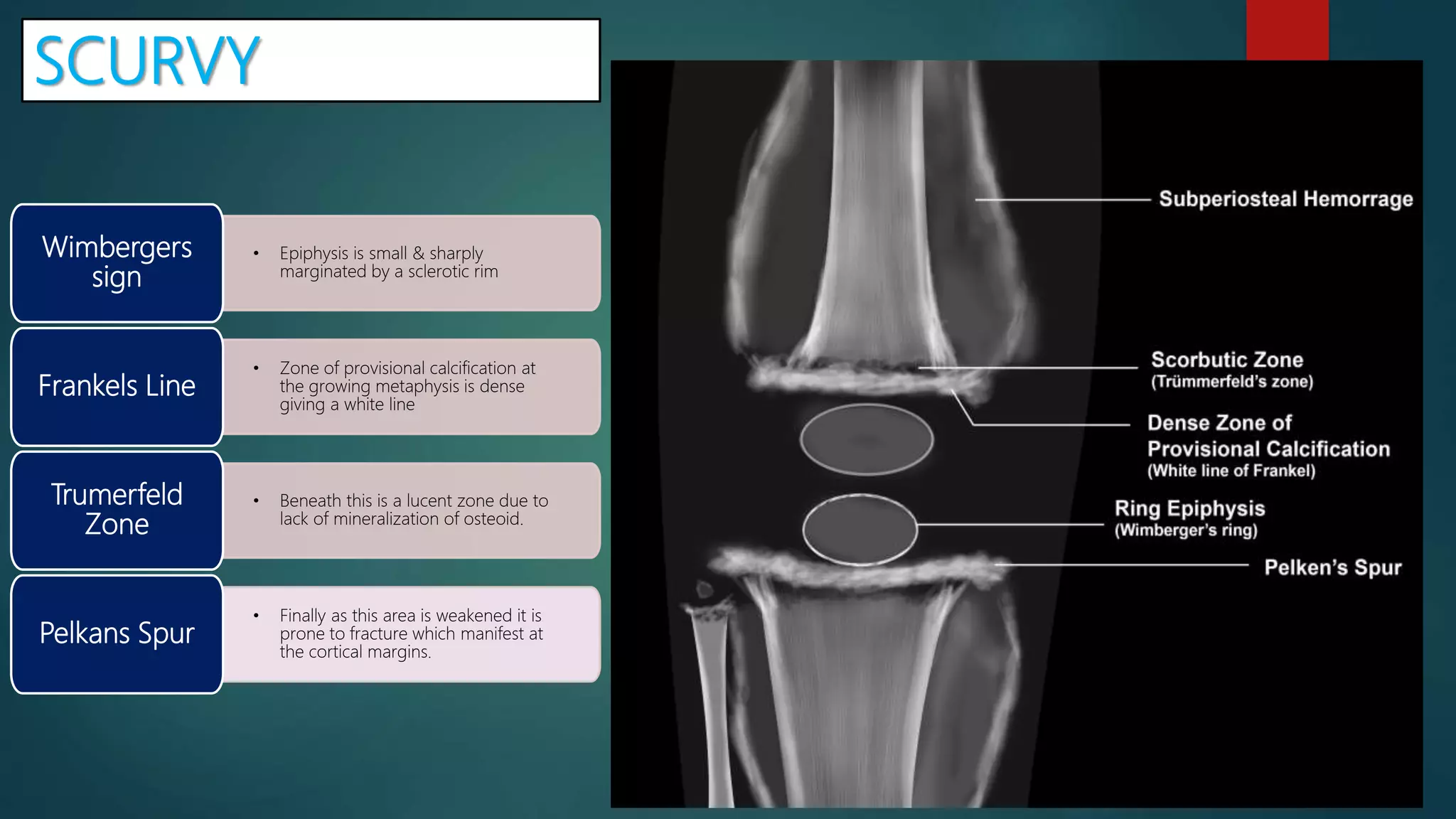 Metabolic & Endocrinal Diseases affecting bone | PPTX
