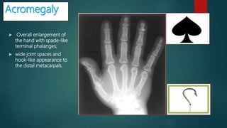 Metabolic & Endocrinal Diseases affecting bone | PPTX