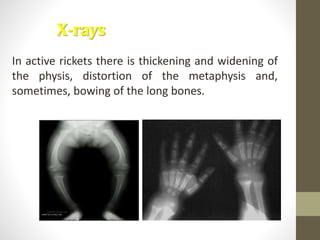 Metabolic bone disease.pptx | Bone and Joint Conditions | Diseases and Conditions