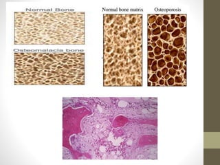 Metabolic bone disease.pptx | Bone and Joint Conditions | Diseases and Conditions