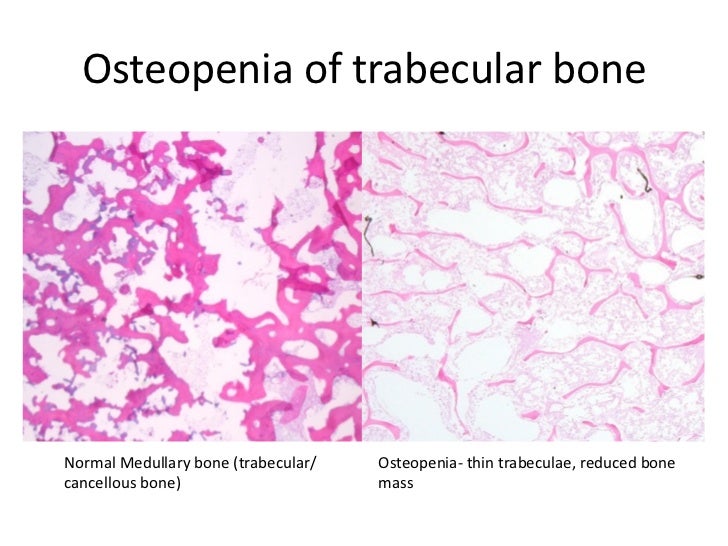 Metabolic bone disease 2011