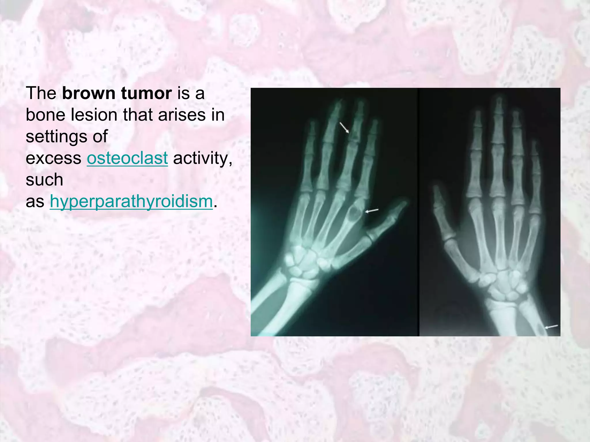 metabolic bone diseases | PPTX