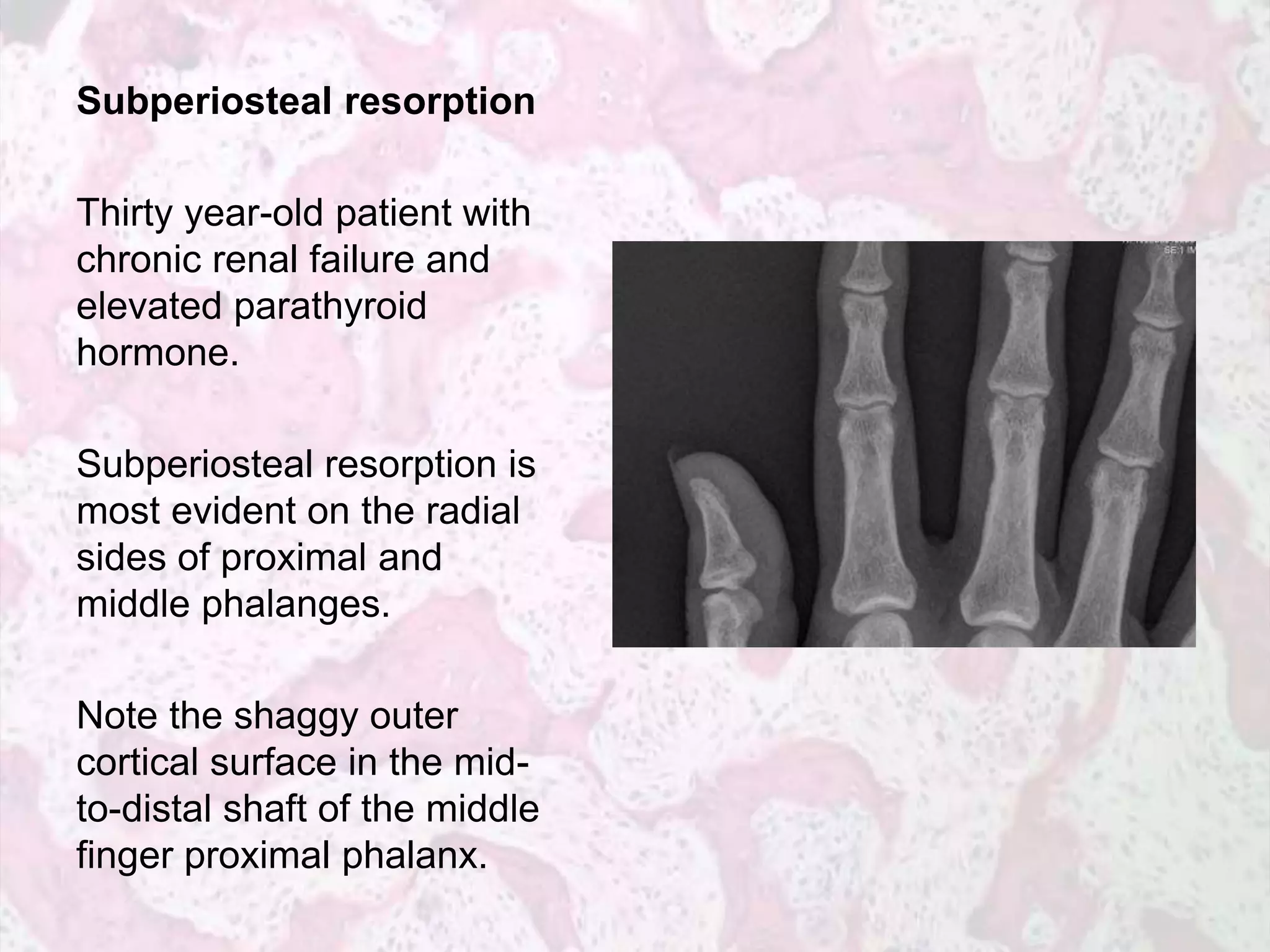metabolic bone diseases | PPTX