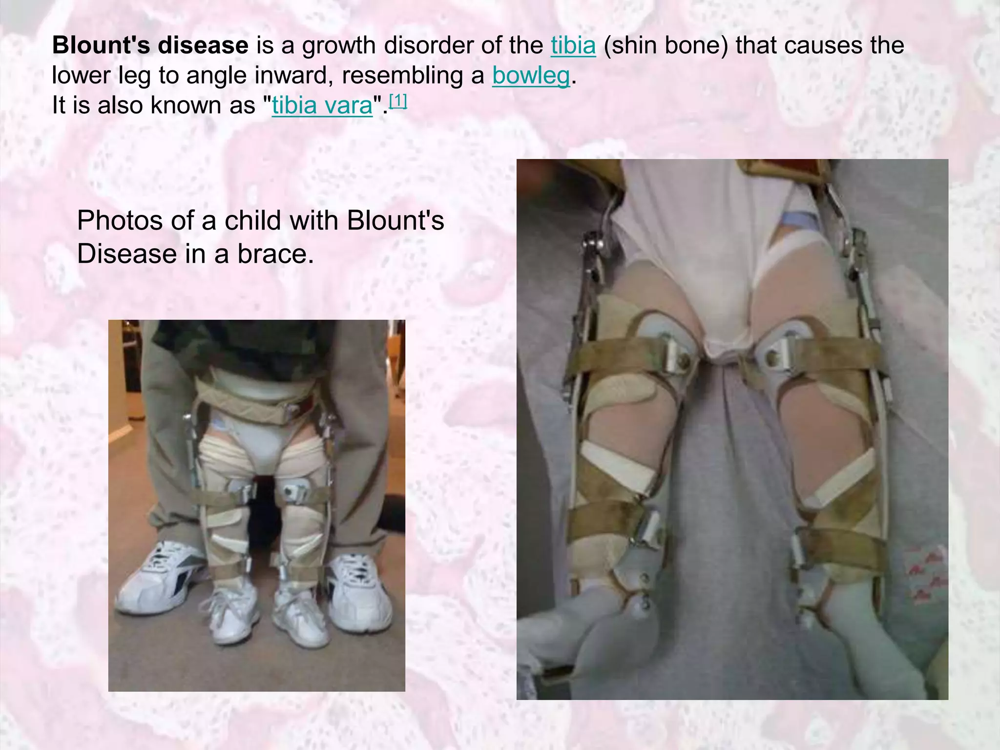 metabolic bone diseases | PPTX