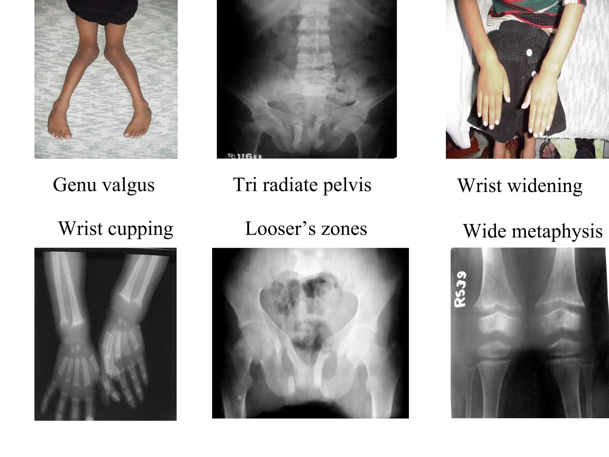 Metabolic Bone Diseases Current Concept | PPT