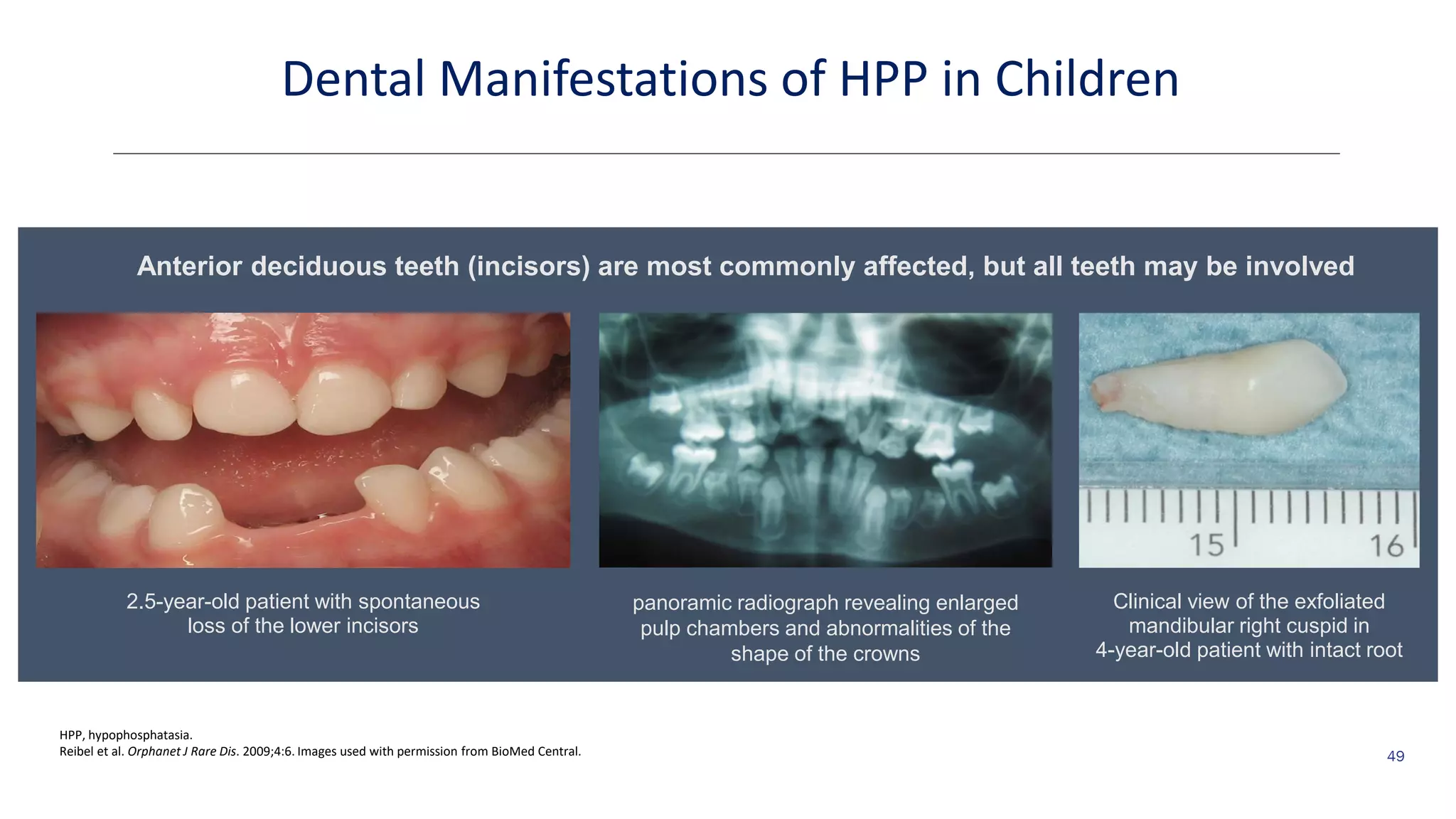 Metabolic bone disease with focus on hypophosphatasia | PPT