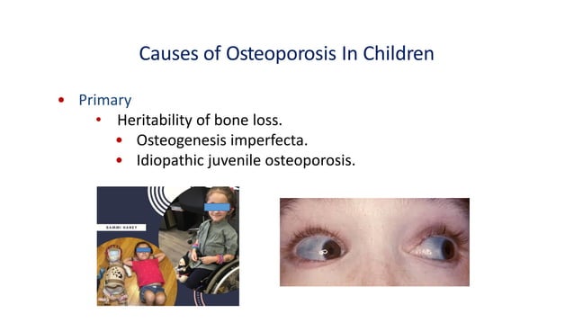 Metabolic bone disease with focus on hypophosphatasia | PPT