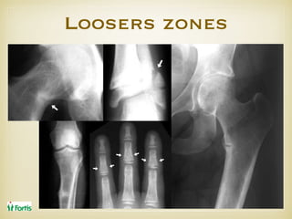 Metabolic bone disorders | PDF