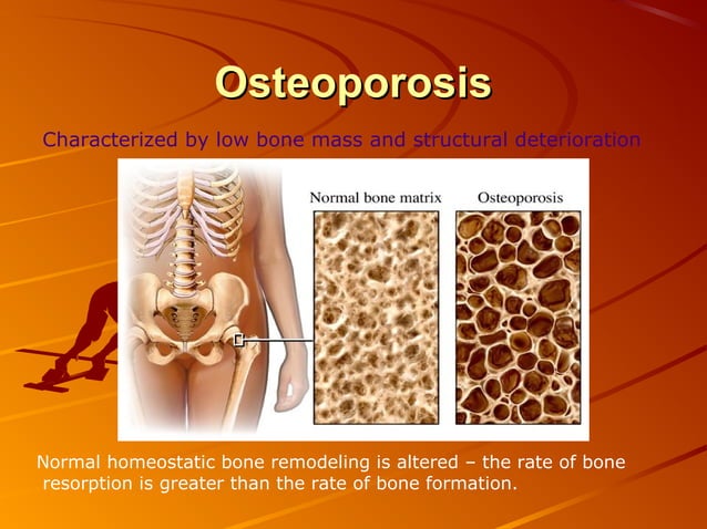 Metabolic bone disorders osteomalacia osteoporosis | PPT