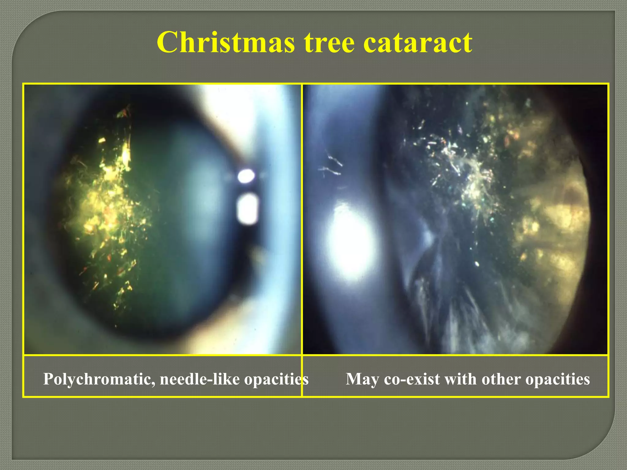 Metabolic & complicated cataract.pptx