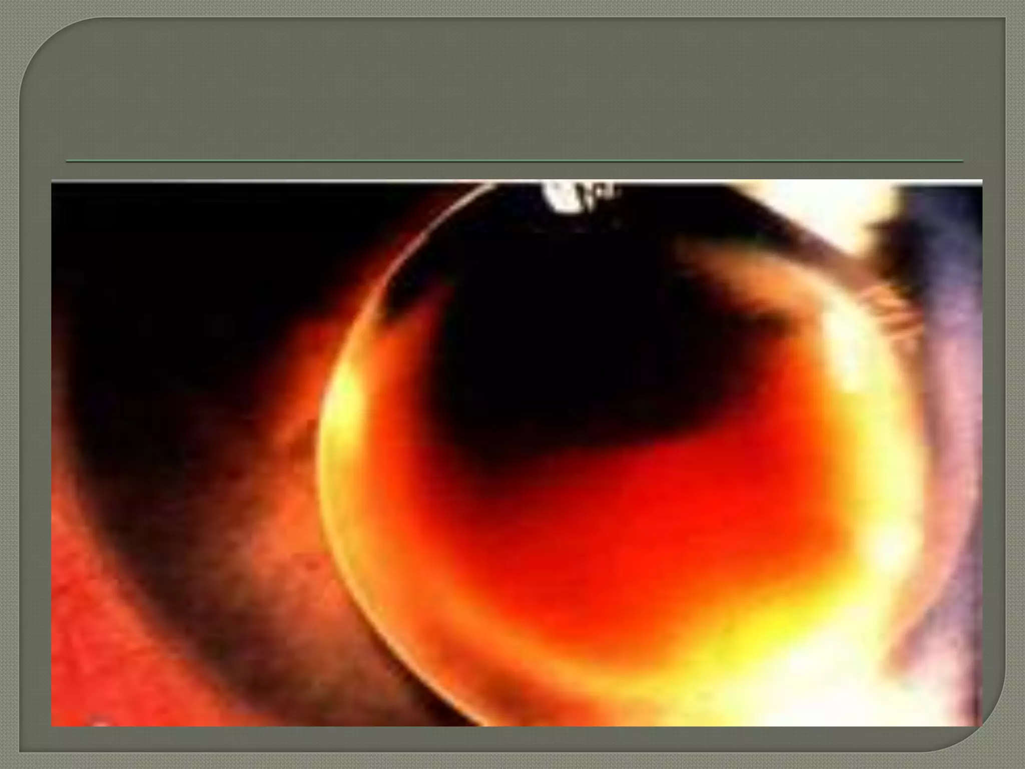 Metabolic & complicated cataract.pptx
