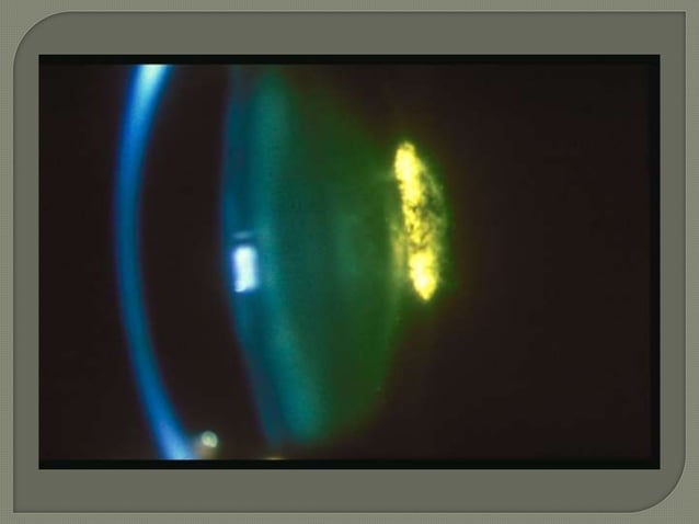 Metabolic & complicated cataract.pptx