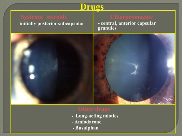 Metabolic & complicated cataract.pptx