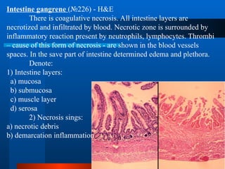 metabolic disorders blood disease pathology anatomy.ppt