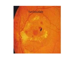 Metabolic disorders of eye ro | PPT