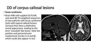 Imaging in Metabolic encephalopathy and dementia | PPTX