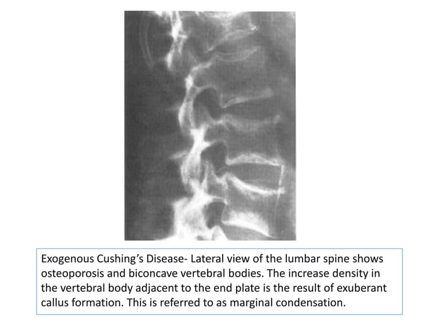 Metabolic & endocrine disorders affecting bone (Radiology) | PPTX