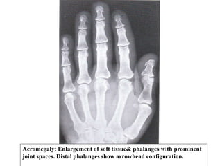 Metabolic & endocrine disorders affecting bone (Radiology) | PPTX