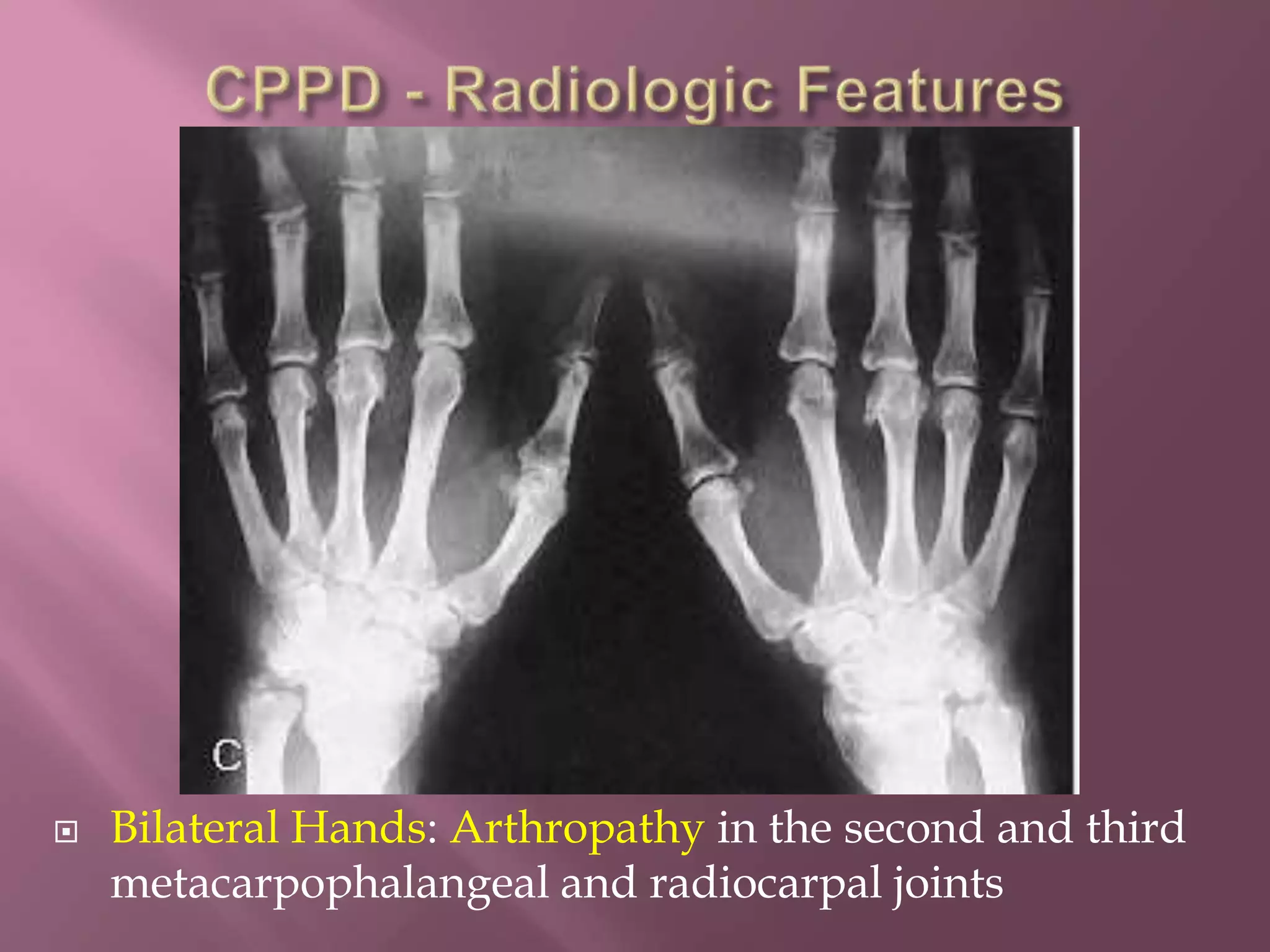 Metabolic (scurvy, gout, cppd, fluorosis) sayid | PPTX